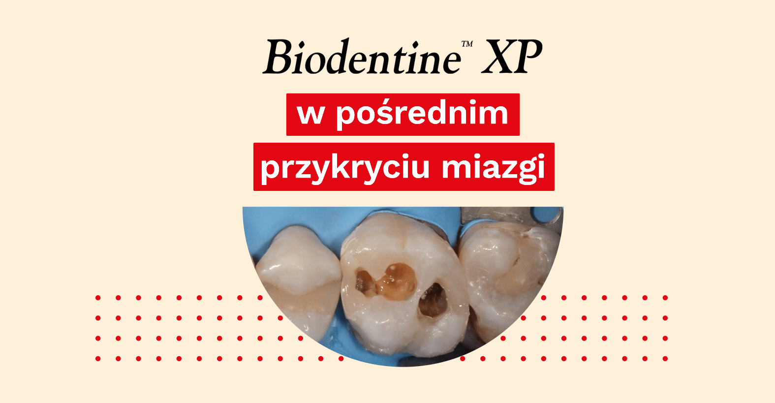 Biodentine XP w pośrednim przykryciu miazgi - clinical case dr Ganowicz